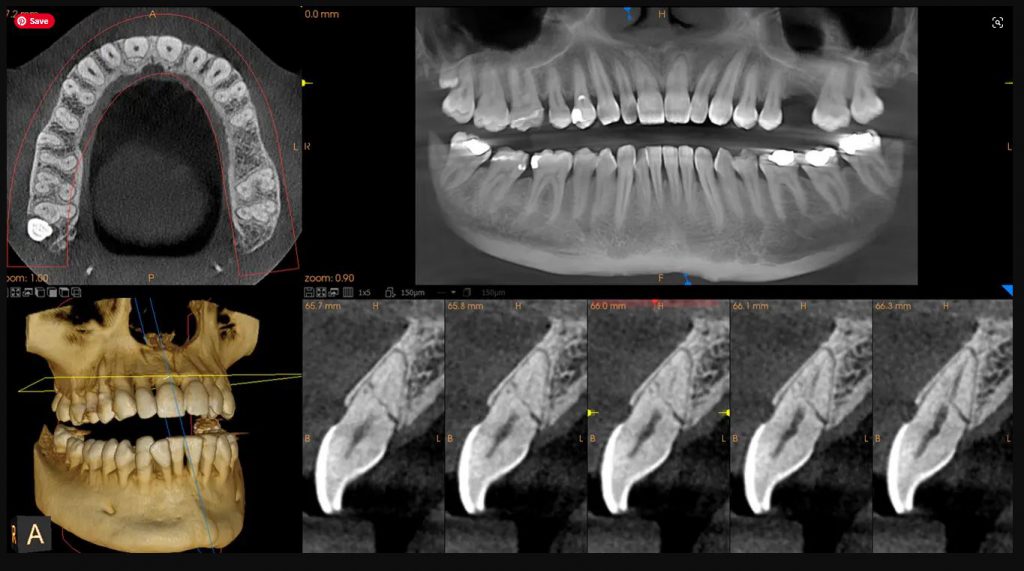 CBCT 3D Imaging – Lynchburg Endodontics